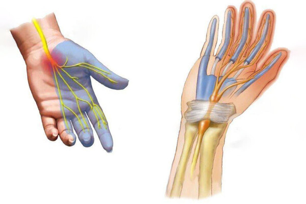 Диагностика и терапия при онемении конечностей